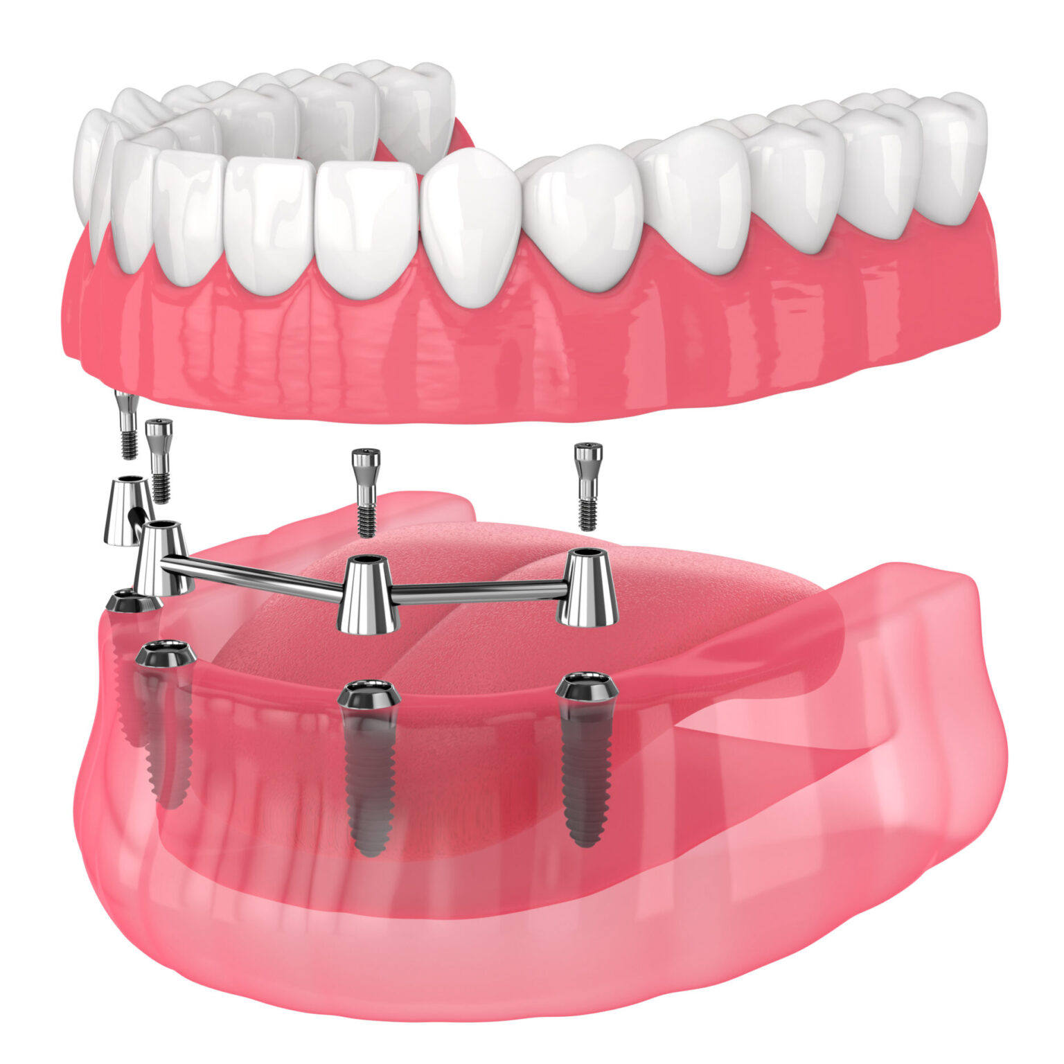 Dentures - Hawk Dental Artistry | Cosmetic Dentist Boca Raton